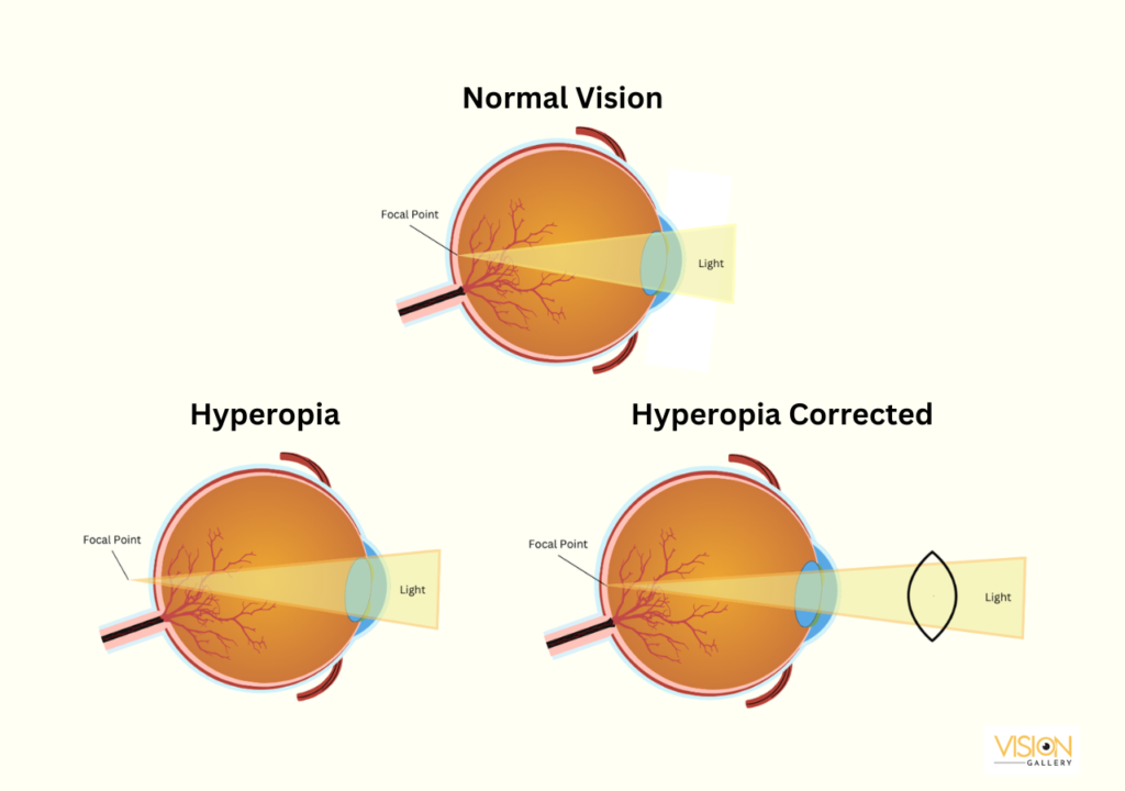 Myopia vs Hyperopia: Key Differences, Symptoms & Treatments