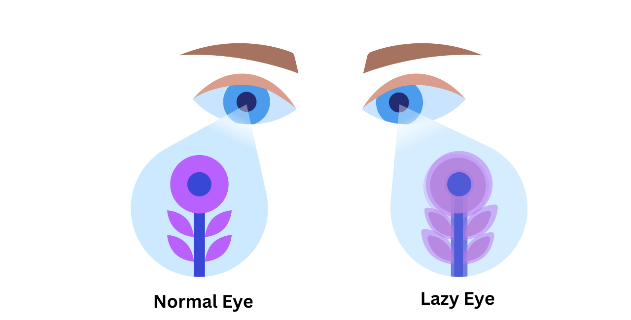 Strabismus vs Lazy Eye: Differences, Symptoms & Treatment